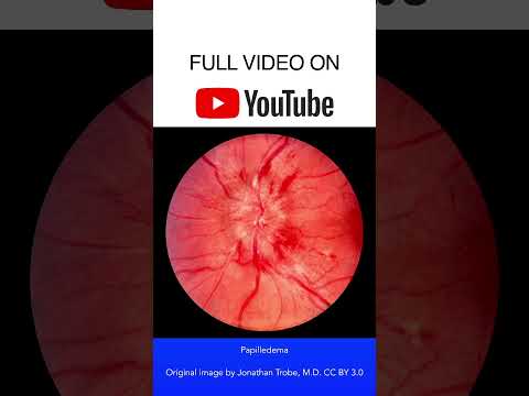 Papilledema Fundoscopy