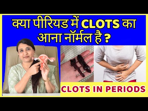 क्या पीरियड में CLOTS का आना नॉर्मल है ? CLOTS IN PERIOD