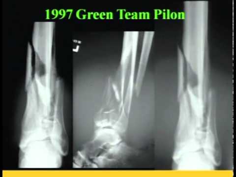 Tibial Plafond Fractures - Trauma - Orthobullets