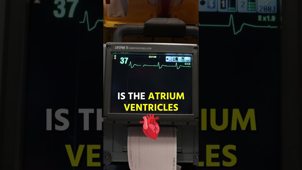 COMPLETE Heart Block on EKG