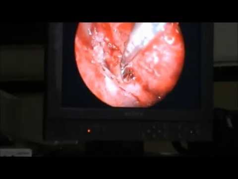 CSF rhinorrhoea cribriform plate