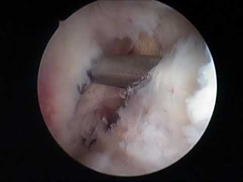 ACL Surgery - Anatomical transportal technique - Arthrroscopy - Dr.Ujjval Deliwala