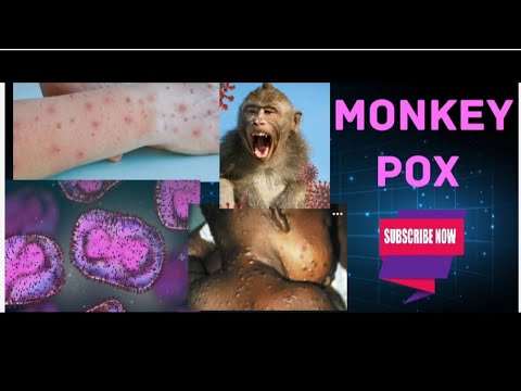 Monkey pox