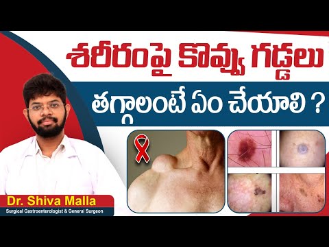 కొవ్వు గడ్డలు తగ్గాలంటే | What is Lipoma in Telugu | Lipoma Causes and Treatment | Prathima Hospital