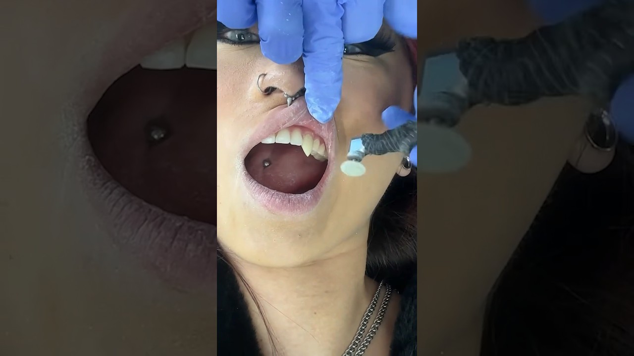 Dentist Reveals The Secrets To Viral Vampire Teeth! 🧛🦷