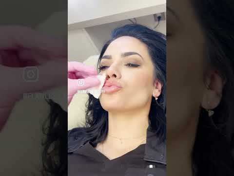 Let’s get a little “Lipsy” with Juvederm! #juvéderm #medspa #lipfiller #newmexico #albuquerque