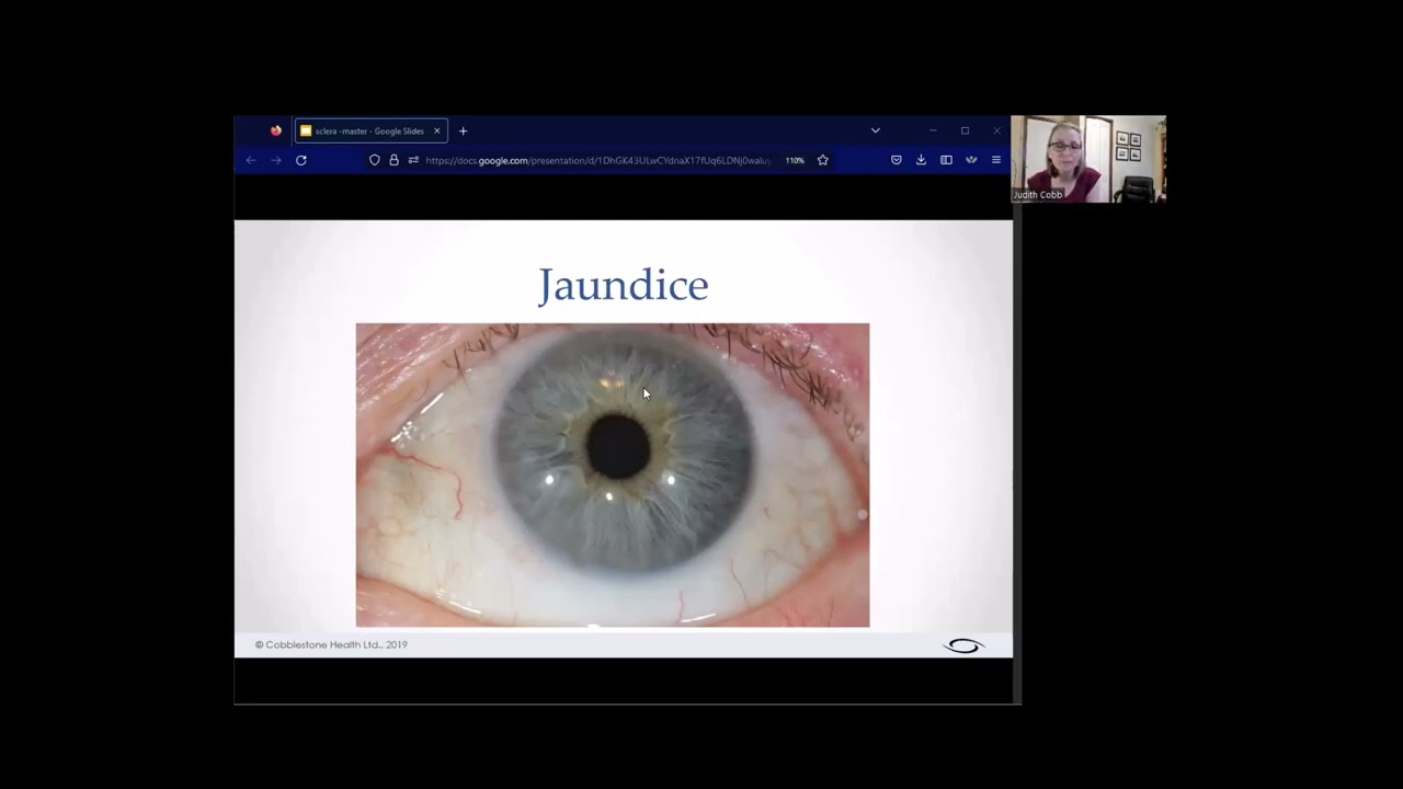 Sclerology as a part of an Iridology Assessment