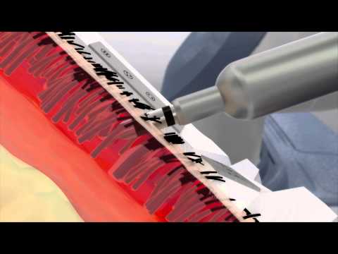 ARTAS: How It Works