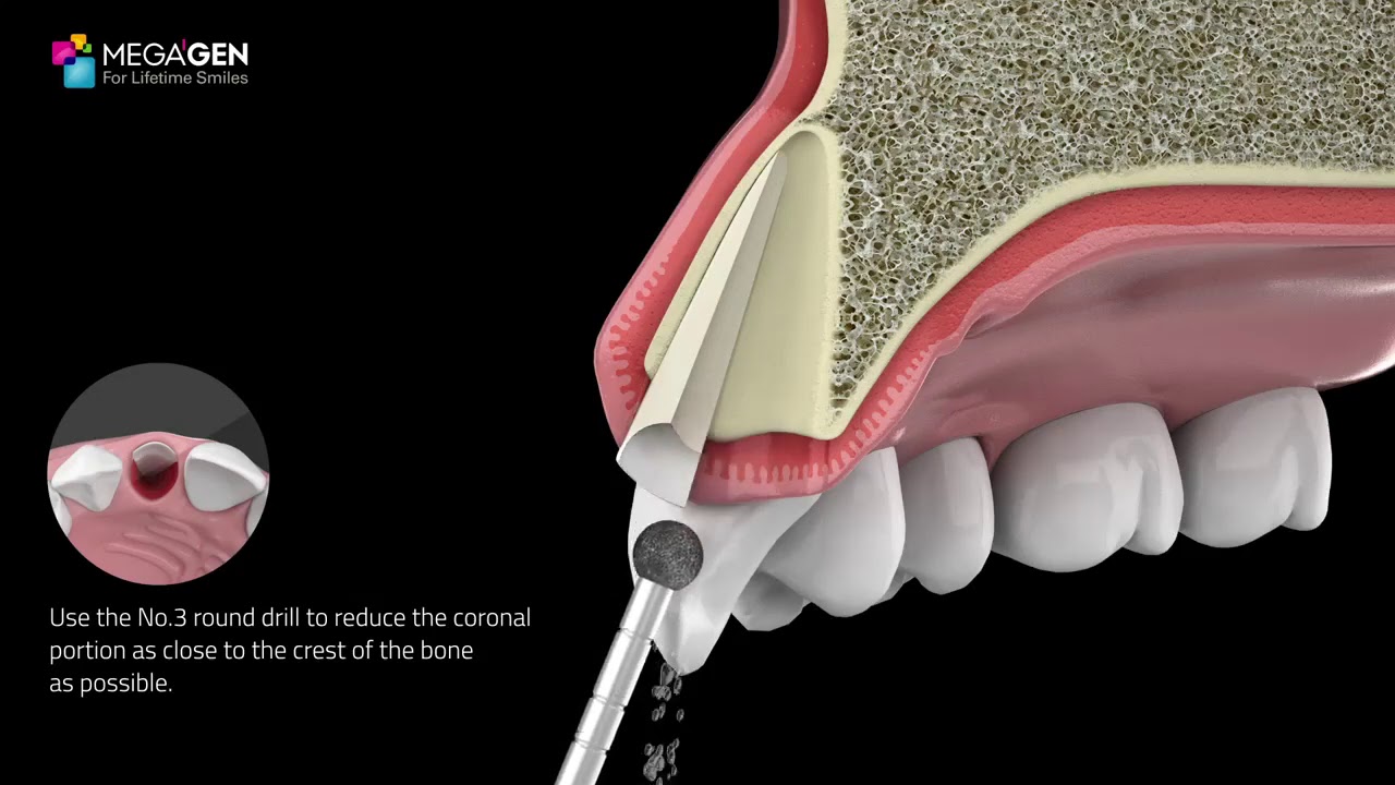 MegaGen PET Kit -  Socket Shield Procedure