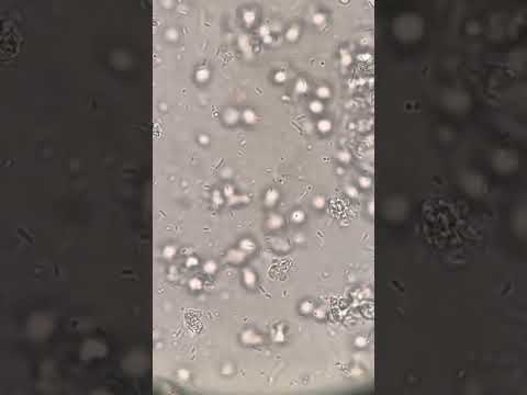 Bacteria in Urine under Microscope #urinalysis #bacteria #microscope #laboratory #labtest