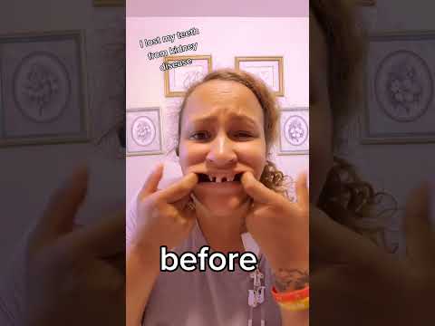 😁 I lost my teeth from Kidney Disease 😁 Instant Smile Teeth Veneers 2025
