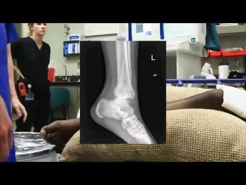 Ankle Fracture Dislocation Reduction