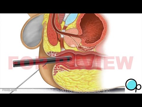 PreOp® Transrectal Ultrasound and Prostate Biopsy | Patient Education