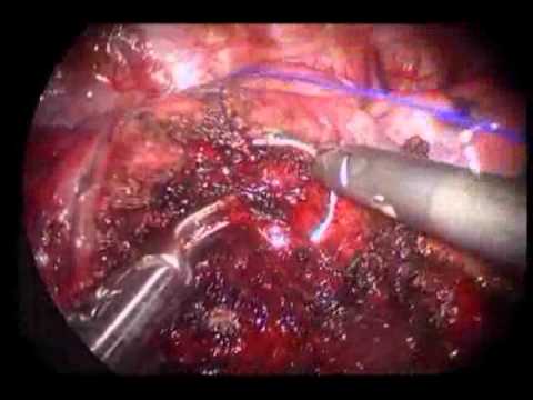 Precision Cautery Excision of Deep-Seated Lung Hamartoma by Video...