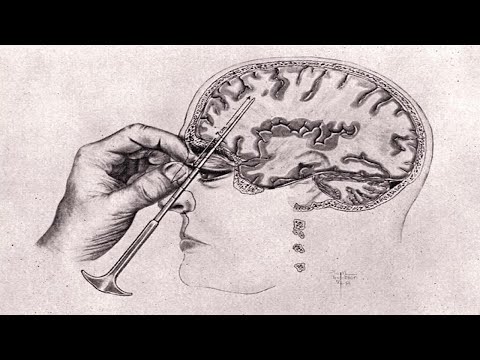 American Sign Language ASL Video Dictionary - prefrontal lobotomy
