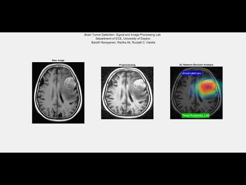Brain Tumor Detection using Deep Learning