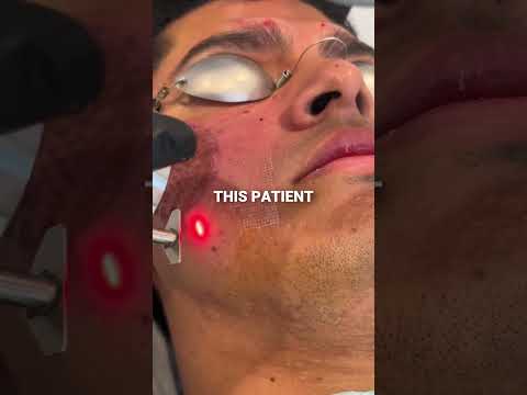 How to treat Icepick + Boxcar Acne Scars #acnescarsremoval #acnescartreatment
