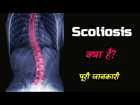 What is Scoliosis with Full Information? – [Hindi] – Quick Support