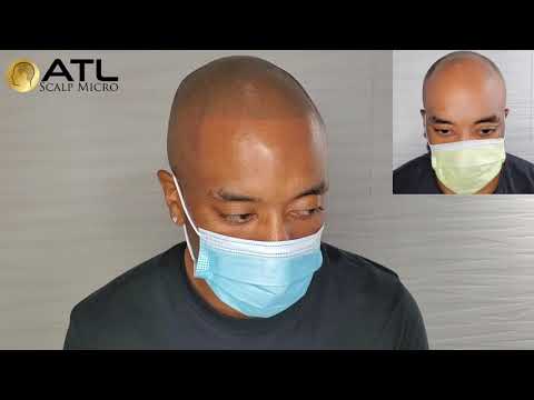 Amazing Hairline Restoration with Scalp Micropigmentation!