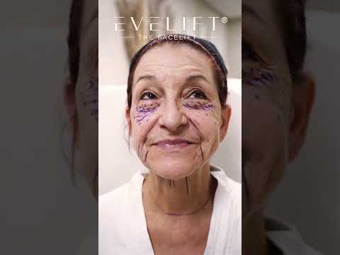 Barbara's 4-Day EVE Lift™ Progression | Eden Plastic Surgery: Dr. Ali Charafeddine, MD
