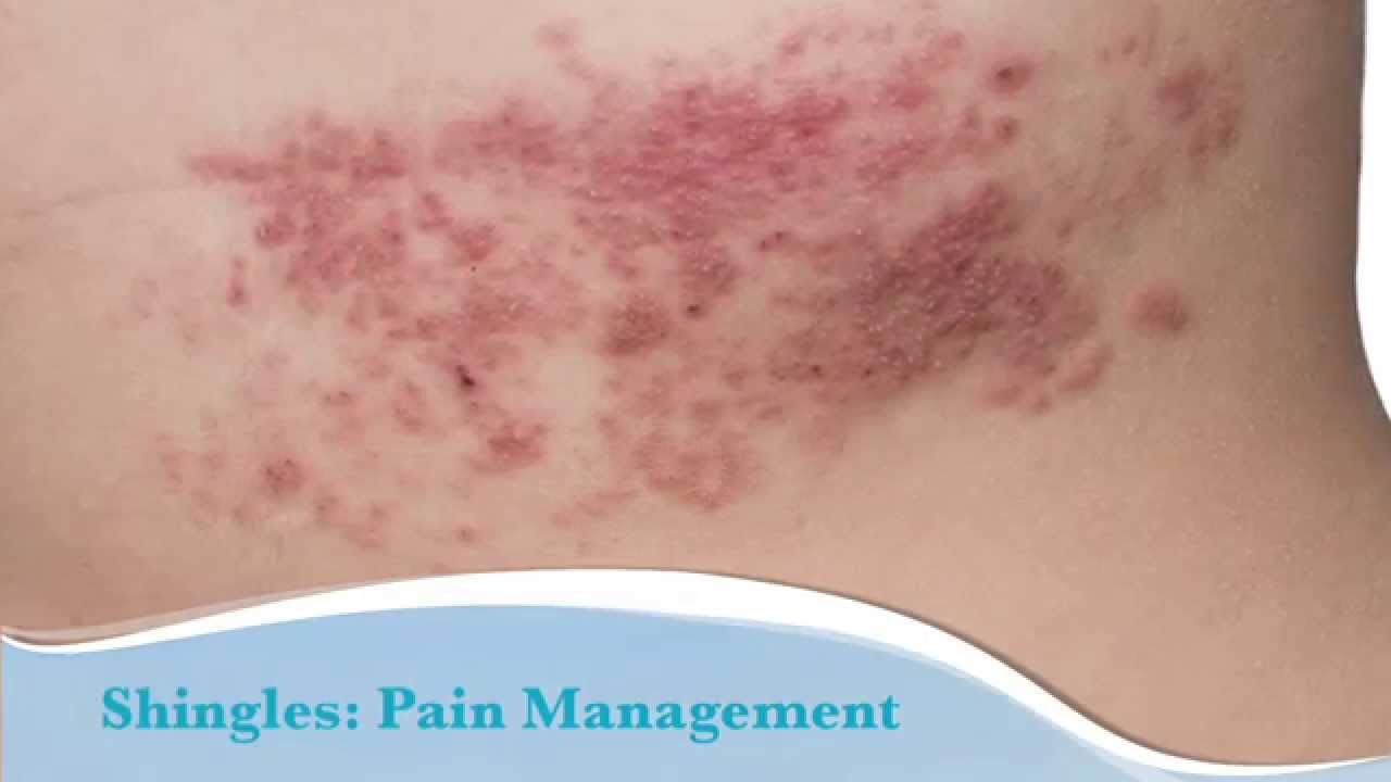 How to treat shingles