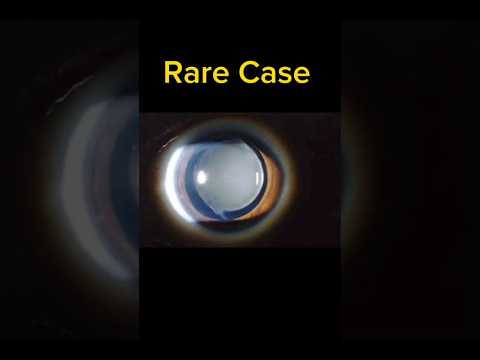 Rare Case of IOL opacification.