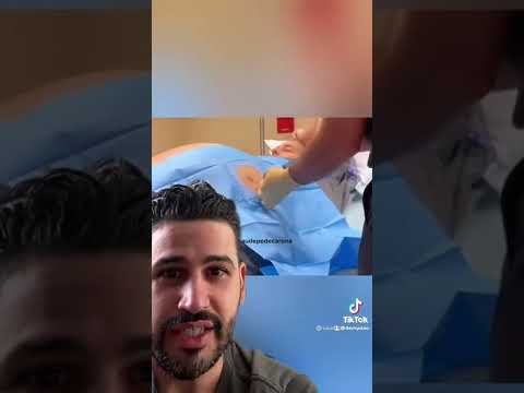 Paracentesis 25 liters removed