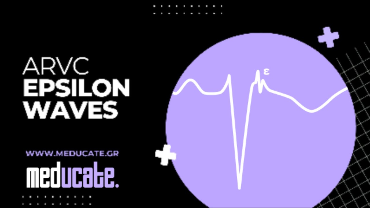 ARVC: Epsilon Waves | meducate studio