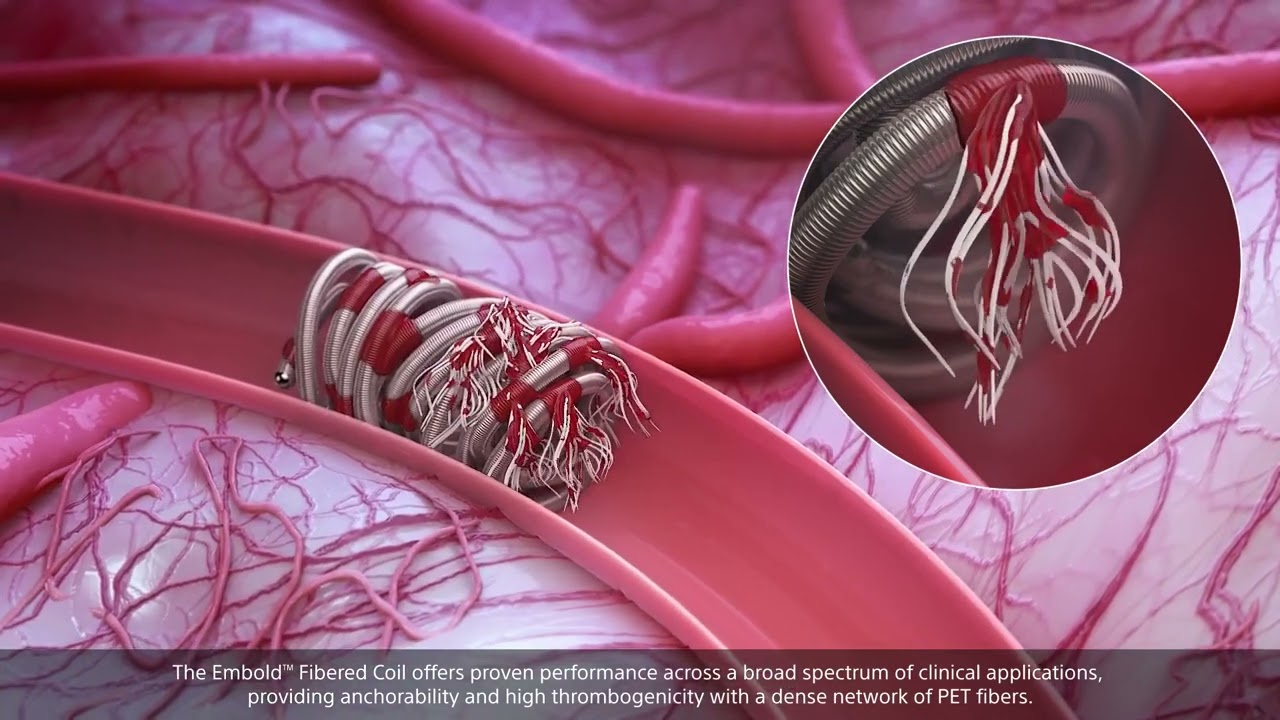 EMBOLD™ Detachable Coil System Embolization Procedure Animation