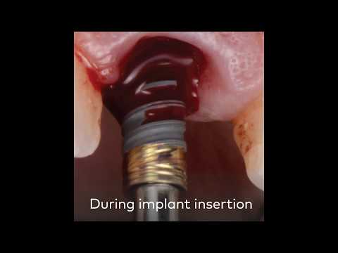 Clinical case: Failing endodontic treatment of a central incisor