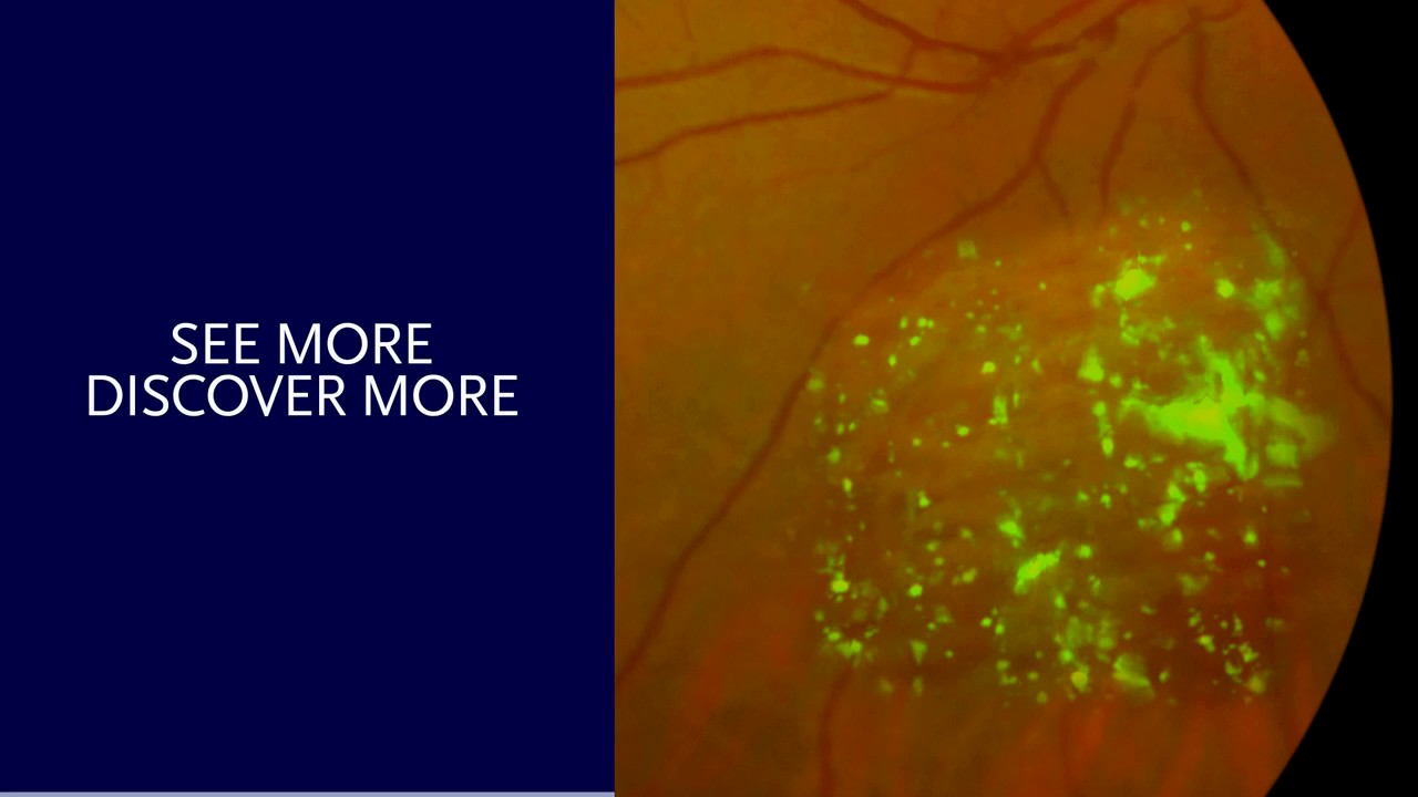 optomap Diagnostic Atlas Video