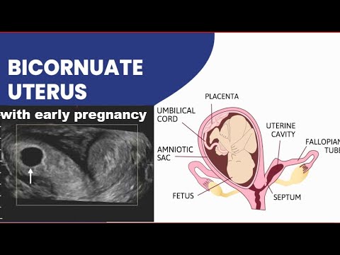 Bicornuate Uterus with early pregnancy