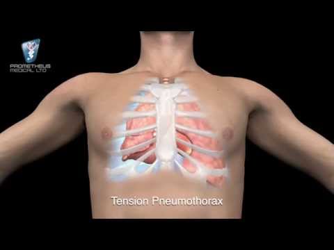 Tension Pneumothorax Needle Decompression