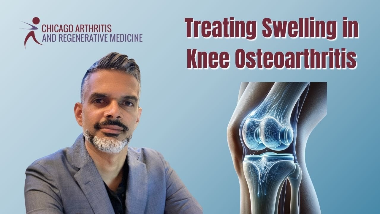 Treating Swelling in Knee Osteoarthritis - Chicago Arthritis and ...