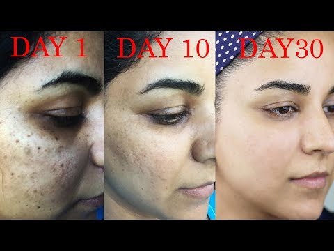How do I get rid of dark scars, hyperpigmentation, acne/acne – Health