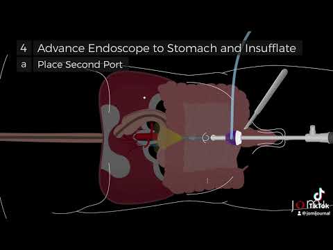Laparoscopic-Assisted Percutaneous Endoscopic Gastrostomy (PEG) Tube Placement Steps