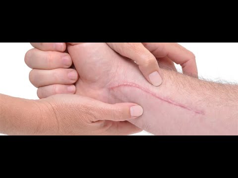 Tips on Management of Scar Tissue