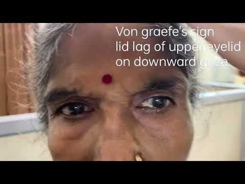 Von Graefe's sign (lid lag) in hyperthyroidism; DMIMSU; Department of Medicine