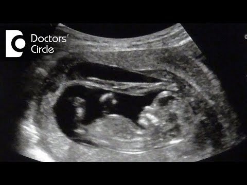 What is the significance of gestational sac size during pregnancy? - Dr. Sunita Pawar Shekokar