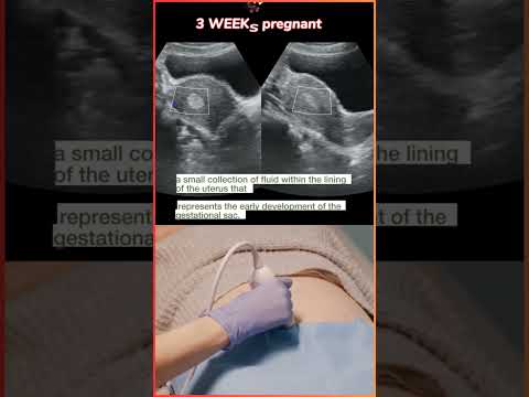3 weeks, pregnancy | ultrasound #baby #ultrasound #pregnant
