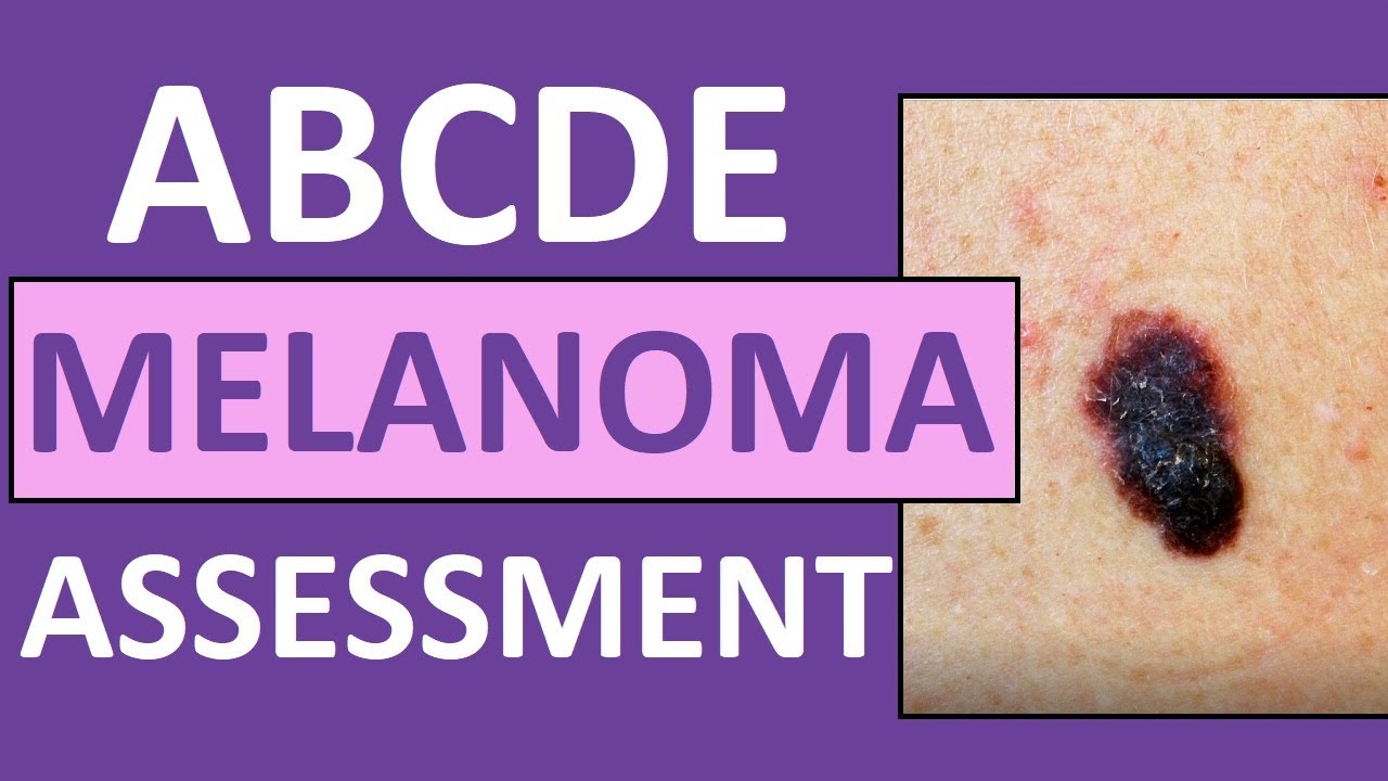 ABCDE Melanoma Skin Cancer Assessment Nursing (with Pictures)