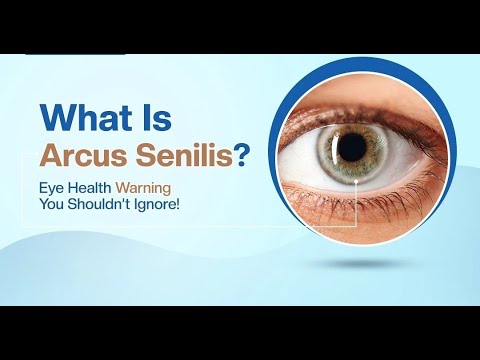 Corneal arcus Or arcus senilis (gray, white, or blue ring forms around the edge of the cornea)