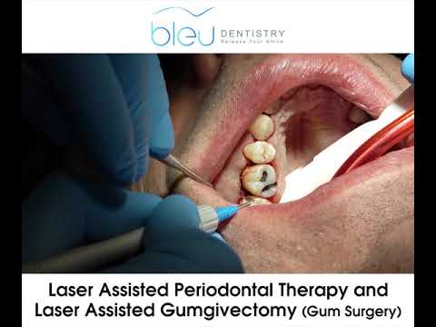 [Bleu Dentistry] Laser Assisted Periodontal Therapy and Laser Assisted Gumgivectomy (Gum Surgery)