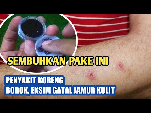 OBAT BOROK KORENGAN GATAL-GATAL EKSIM, PK SERBUK