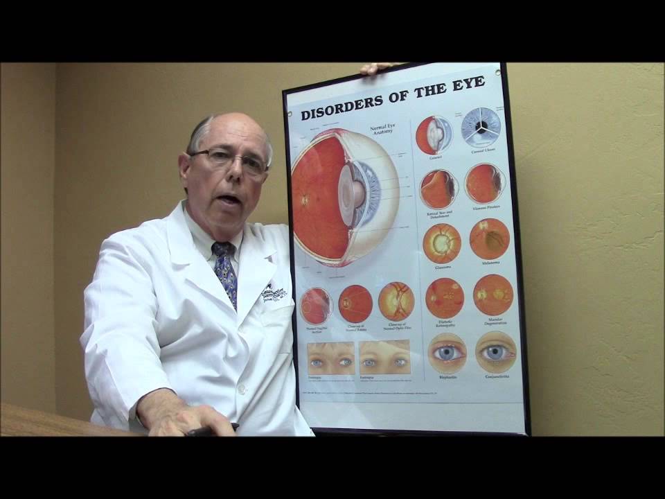 Pseudoexfoliation with Cataracts and Glaucoma