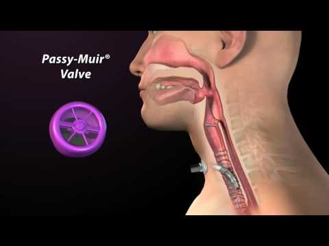 Cuff Deflation and Placement of the Passy Muir Valve