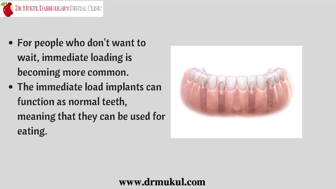 Dental Implants In Bandra | Dental Implants In Mumbai