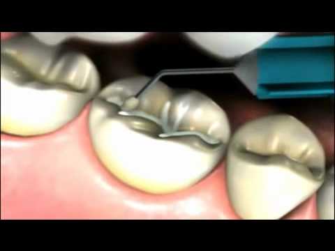 Dental Sealant