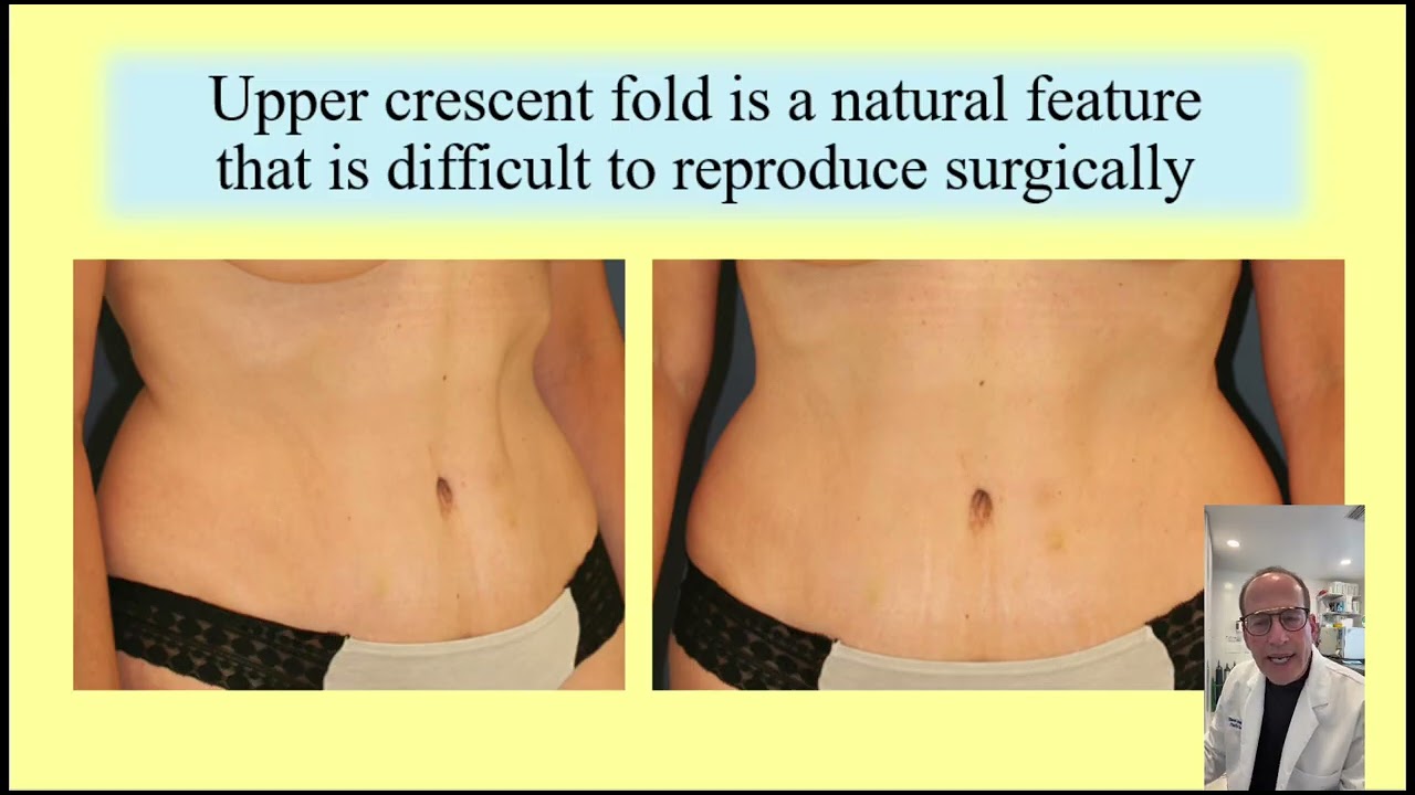 The Aesthetic Belly Button After Tummy Tuck