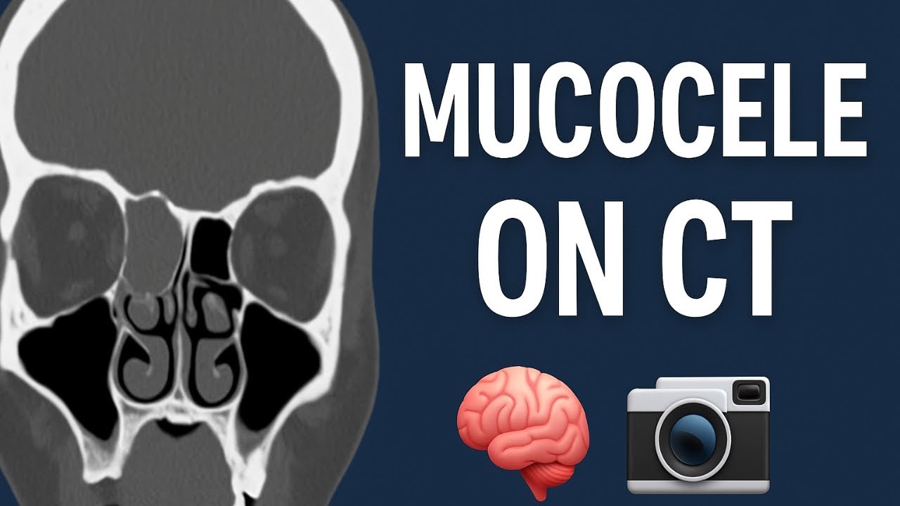 Frontal Mucocele on CT: 3 Key Signs You Must Know 🧠📸